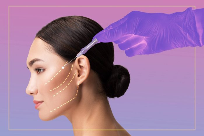 Thread lift - Invivo Hospitals