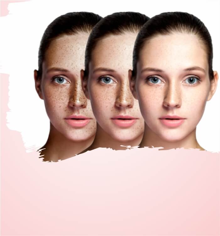 Freckles - Invivo Hospitals